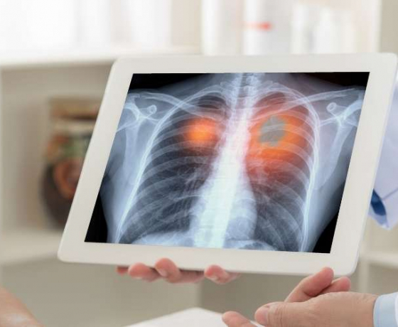 A Quick Guide to Sarcoma, Lumps and Bumps - Donald Poon and Associates